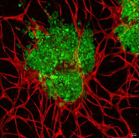 Studying Tumor Angiogenesis And Cancer Invasion In A 3d Vascularized