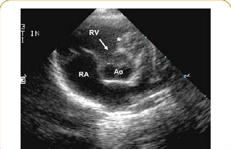 A Two Dimensional Echocardiography Of A Neonate With Large Vsd