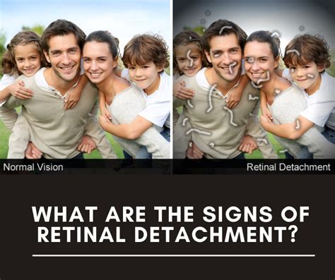 Detached Retina Vision