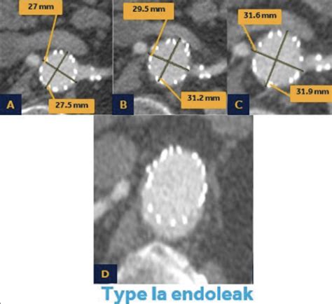 The Current Landscape Of Endosuture Aneurysm Repair Esar Endovascular Today