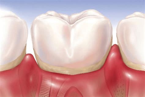 What Are The Symptoms Of Necrotizing Gingivitis Panda Oral