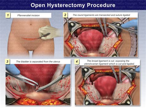 Hysterectomy Surgery