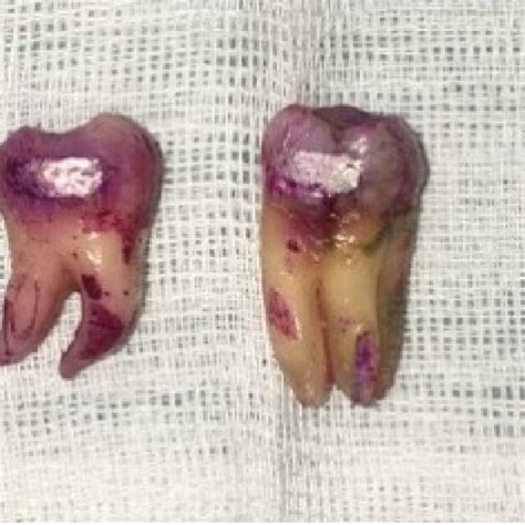 Class V Amalgam Filled Teeth That Were Imaged Through Mri Were Held In