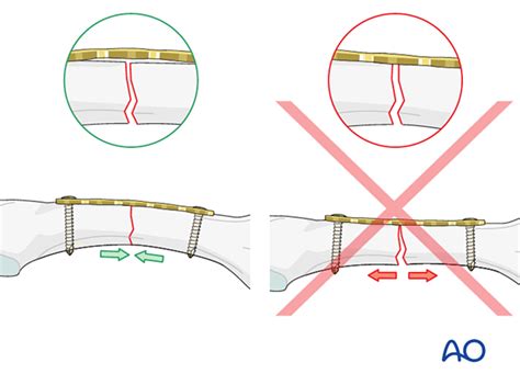 Compression Plating For Simple Transverse Fracture Of The Diaphysis