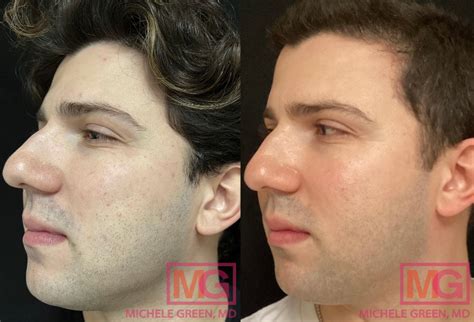 Acne Scars Before And After Laser