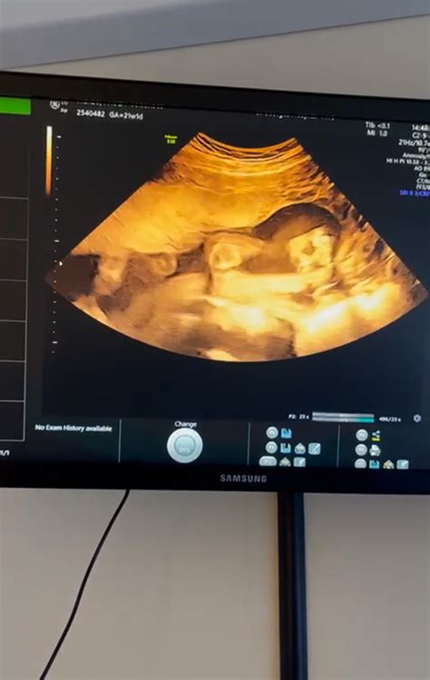 What To Expect At Your Anomaly Scan Vanity Owl