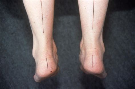 Podiatrists Melbourne Brunswick And Sandringham Foot Clinic