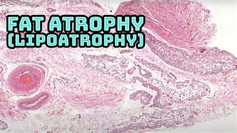 Lipoatrophy Fat Atrophy Possible Mimic Of Liposarcoma And Signet Ring