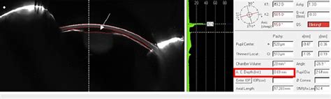 Pentacam Photograph Of The Right Eye Demonstrating Narrow Angles And A Download Scientific