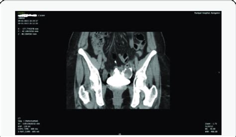 Ct Cystography Defect In Urinary Bladder With Extravasation Of Contrast Download Scientific