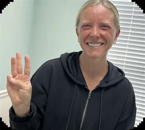 Dermatology Perioral Dermatitis Azova