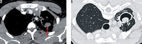 Aftermath Of Pulmonary Tuberculosis Computed Tomography Assessment