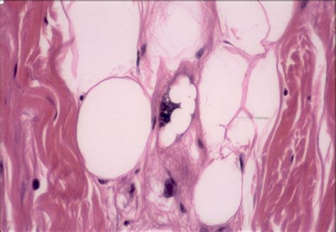 Liposarcoma Libre Pathology