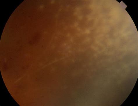 Case 1 Superonasal Retina Right Eye There Are Nummular Patches Of A
