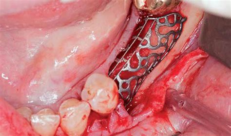 Vertical Defect In The Posterior Mandible 3 Teeth Gap Geistlich