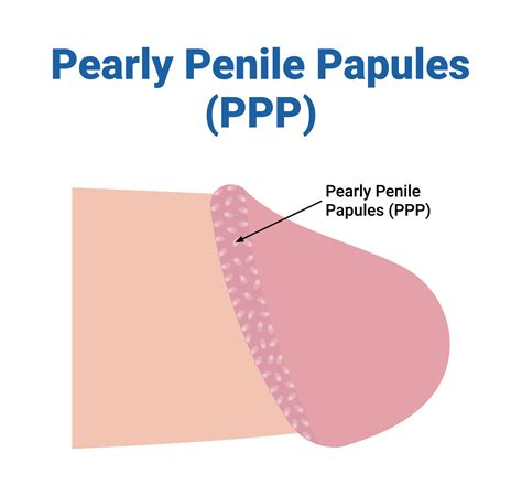Pearly Penile Papules Wat Zijn Dat Simpto Nl