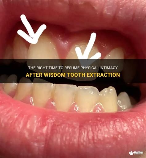 the right time to resume physical intimacy after wisdom tooth