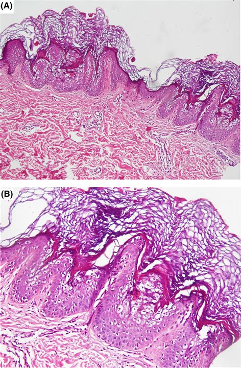 Epidermolytic Hyperkeratosis Histopathology