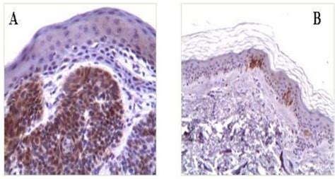 Immunostaining Patterns Of P16ink4a Bcc A With High Number Of