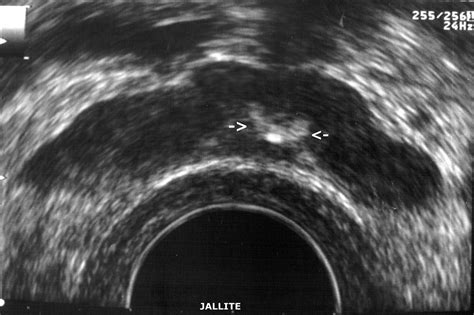 Nodulo Solido Vesicula Seminal