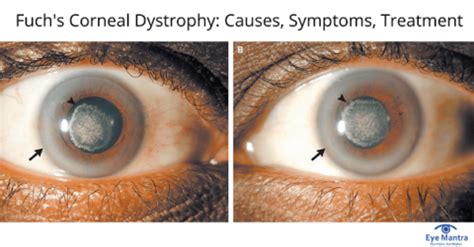 Fuchs Corneal Dystrophy Causes Symptoms Treatment