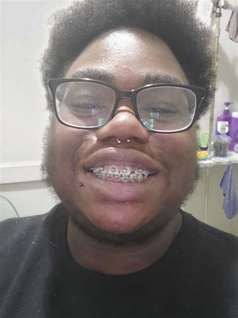 Day 1 With Braces I Saved Up For The Past Month And Finally My Braces