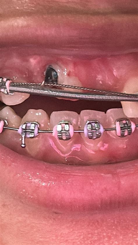 2yrs With Braces 3 Surgeries In And My Impacted Tooth Is Finally