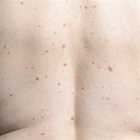 Why Did This Woman Suddenly Develop Thousands Of Moles All Over Her