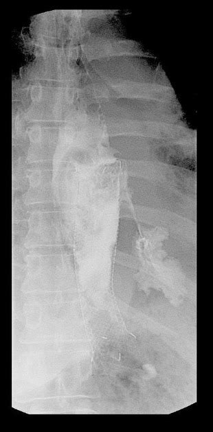 True Vs False Diverticulum