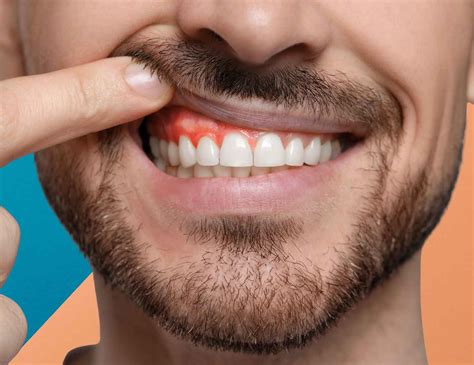 Understanding Periapical Tooth Abscess Toronto Dental Clinic