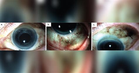 Conjunctiva Resolving Conjunctival Prolapse Following Severe