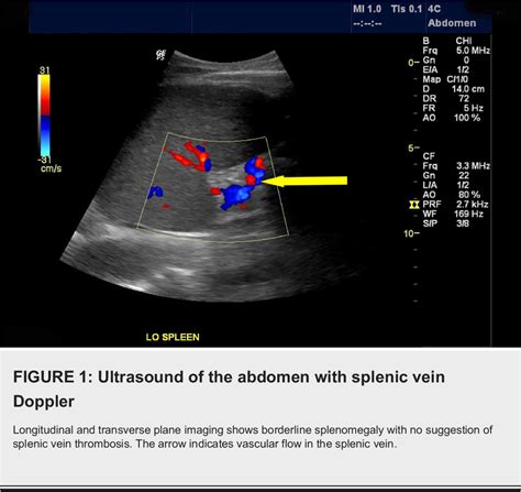 Figure 1 From Isolated Gastric Varices Due To Essential Thrombocytosis