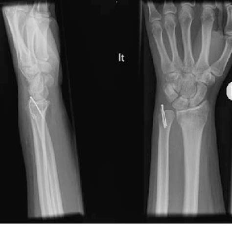 Ulnar Styloid Process Palpation