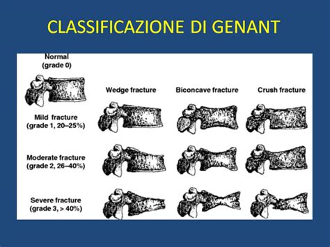Le Fratture Vertebrali Radiologia Ortopedica