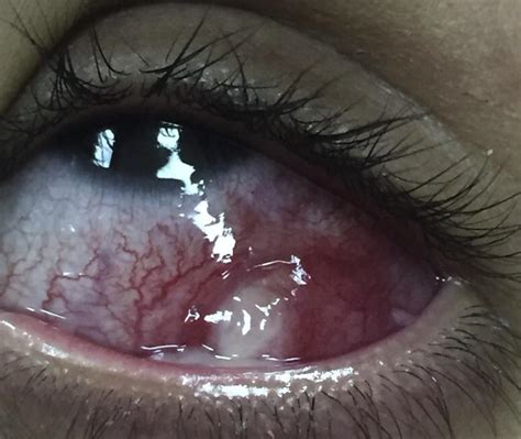 Infected Conjunctival Pyogenic Granuloma At Strabismus Surgery Site Mimicking Conjunctival