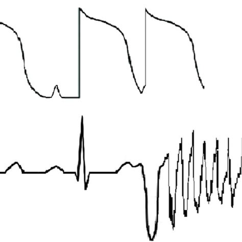 Two Delayed Afterdepolarizations A The Latter Initiating A Premature