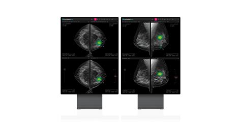 Lunit Nets Fda Nod For Ai Powered 3d Breast Tomosynthesis Solution Lunit Insight Dbt