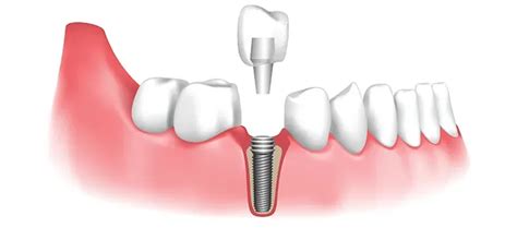 Are Dental Implants Safe In Holistic Dentistry Marrero La
