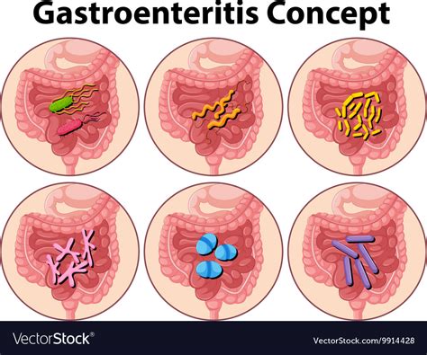 Diagram Showing Gastroenteritis Concept Royalty Free Vector
