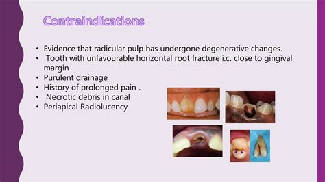 Apexogenesis And Apexification Pptx
