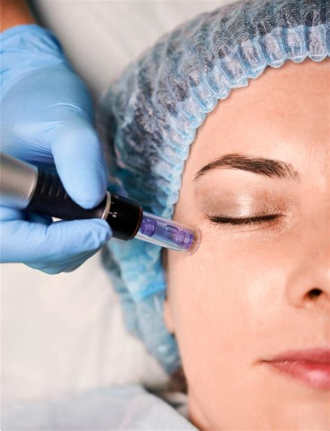 Dermapen Scar Treatment In Istanbul Turkey Estevien Clinic