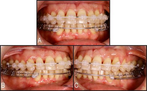 Occlusal Analysis Dental At Jason Rocha Blog