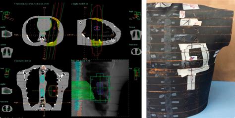 Dosimetric Comparison Of Treatment Planning Systems Using Collapsed