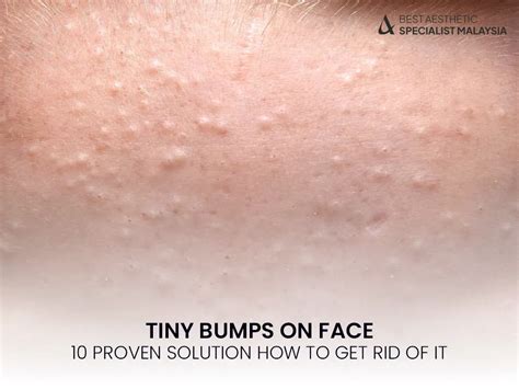 Tiny Bumps On Face Treatments To Clear Skin In