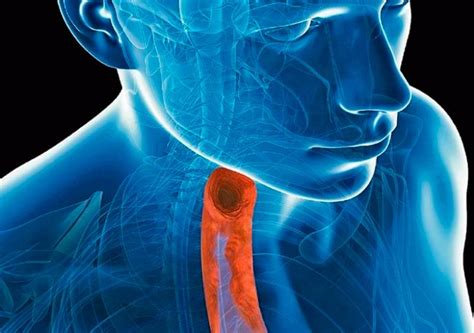 Tratamiento Para La Esofagitis