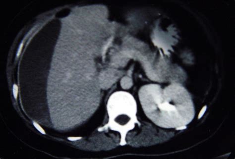 Liver Hematoma 2791 Liver Subcapsular Hematoma 1 Surgery Photos