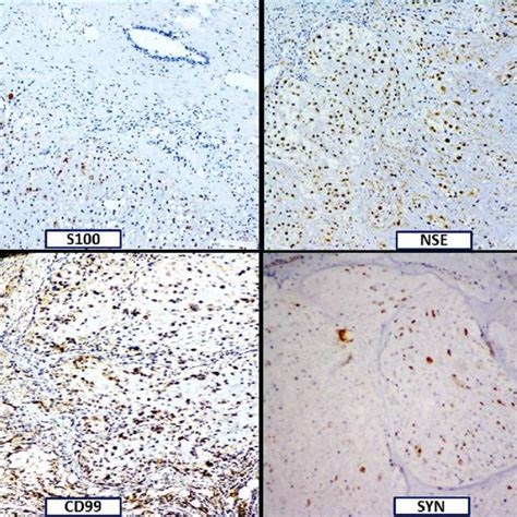 Immunohistochemical Characteristics Of Primary Extraskeletal Myxoid
