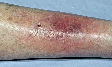 Cellulitis Nice Cks Diagnosis And Management Of Lower Limb Cellulitis