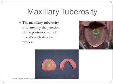 Maxillary Tuberosity Anatomy