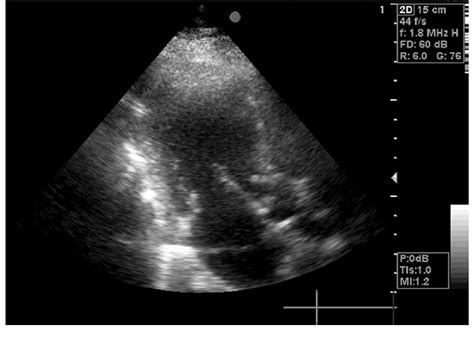 Infective Endocarditis Echo